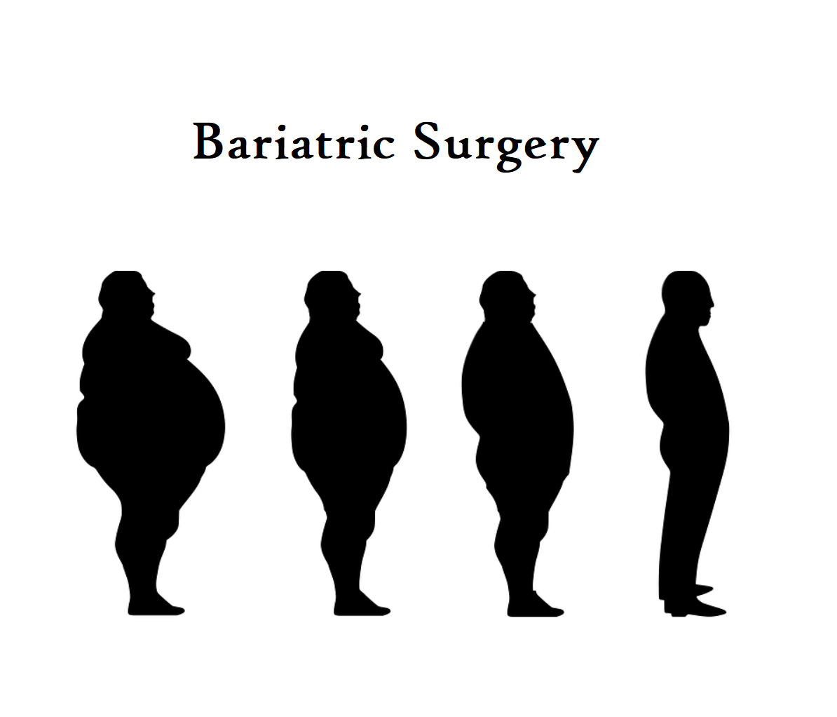 Different Types Of Weight Loss Surgery: Pros And Cons